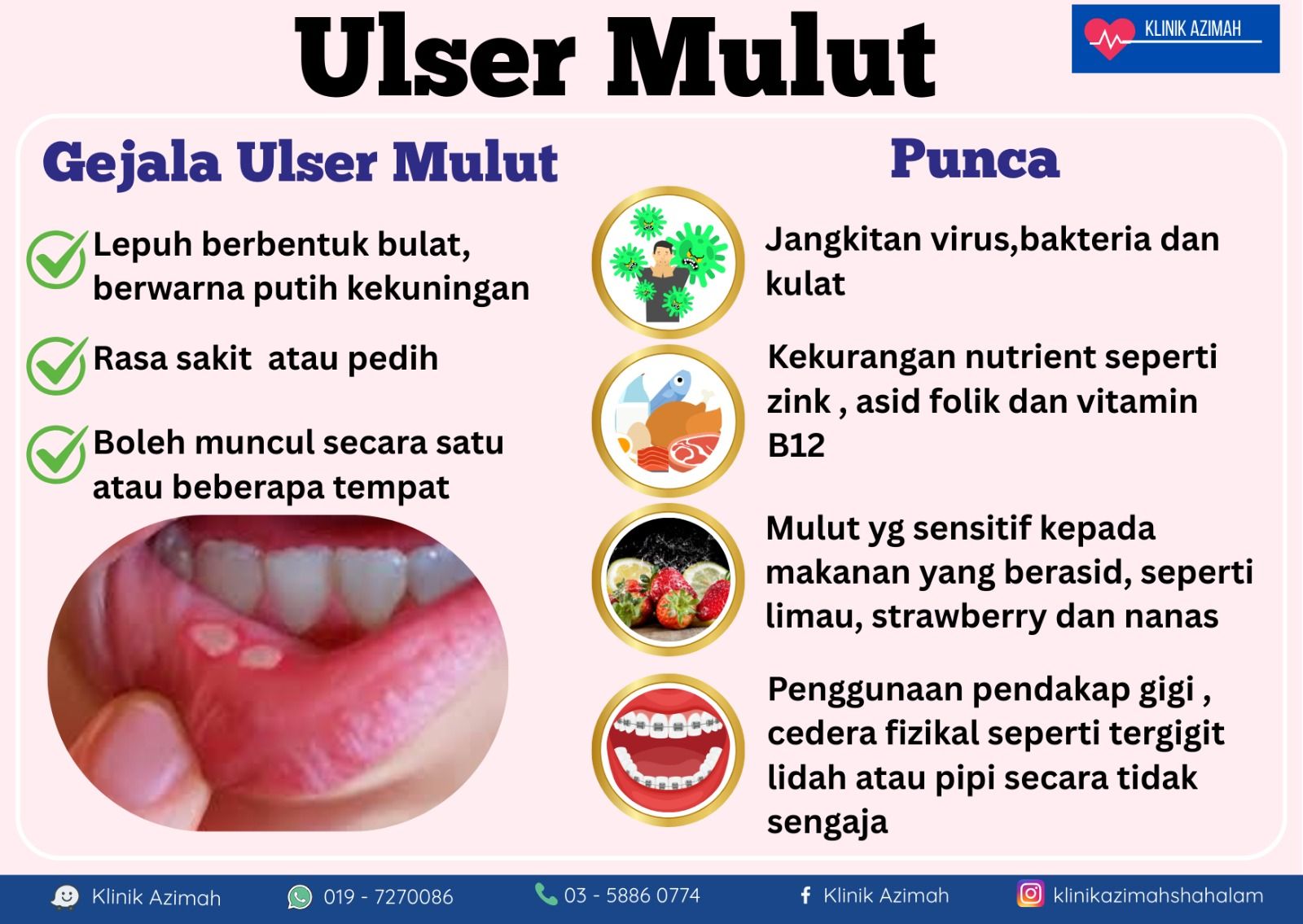 Ulser mulut dan lidah - Info Sihat Bonda